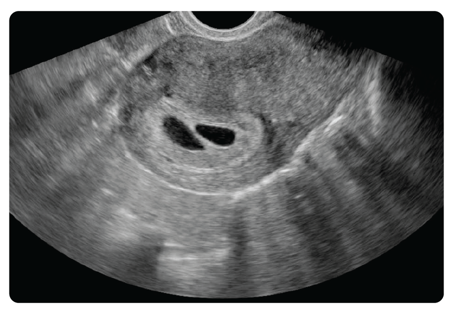 Ultrasound Scan – Fetal Scan Centre